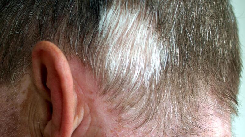 white forelock causes