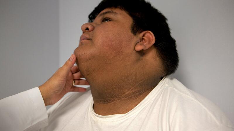 Acanthosis Nigricans: Appearance, Causes, and Treatment