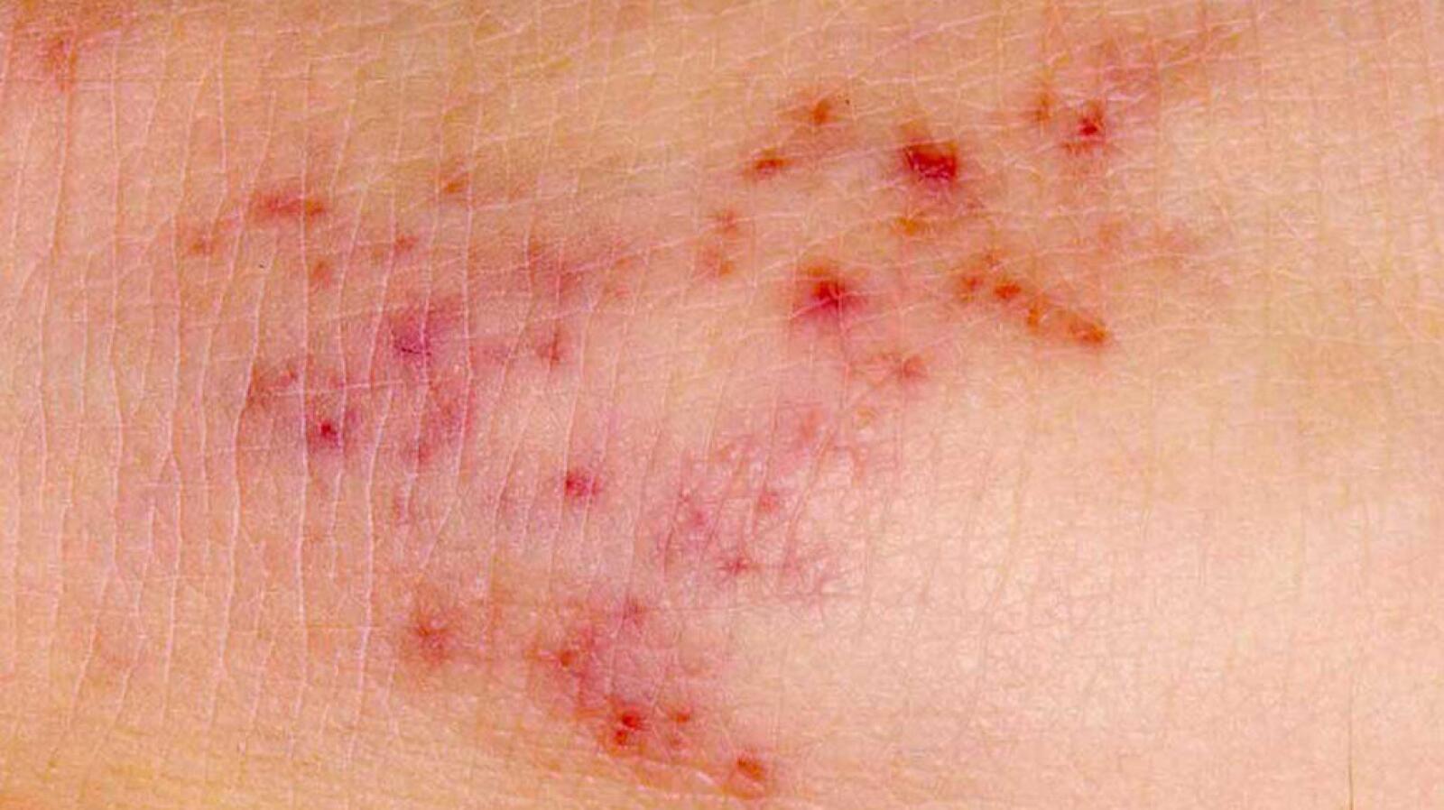 Red Spots on Skin - Causes and Treatment