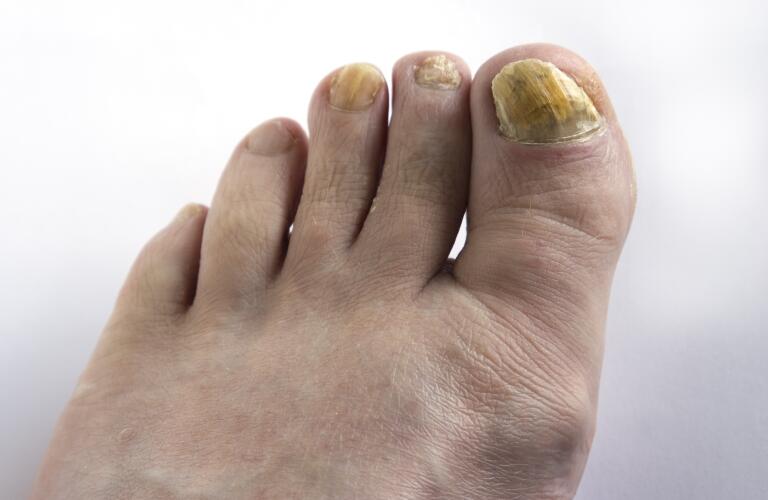 Toenail Problems: Fungus, Thickening & Yellow Toenails