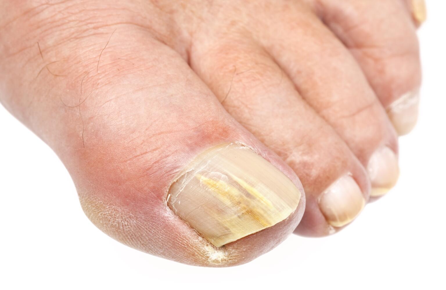 Toenail Problems: Fungus, Thickening & Yellow Toenails