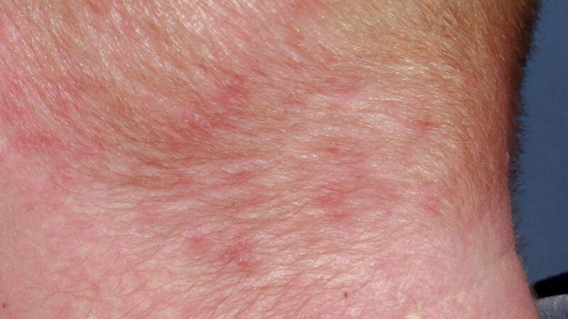 Scalp Folliculitis: Signs, Causes, Treatment, and More