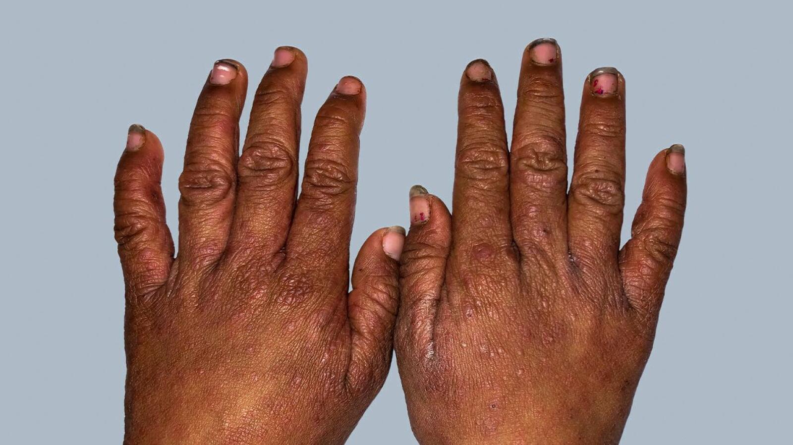 Rash on Stomach: Causes, Symptoms, and Treatment