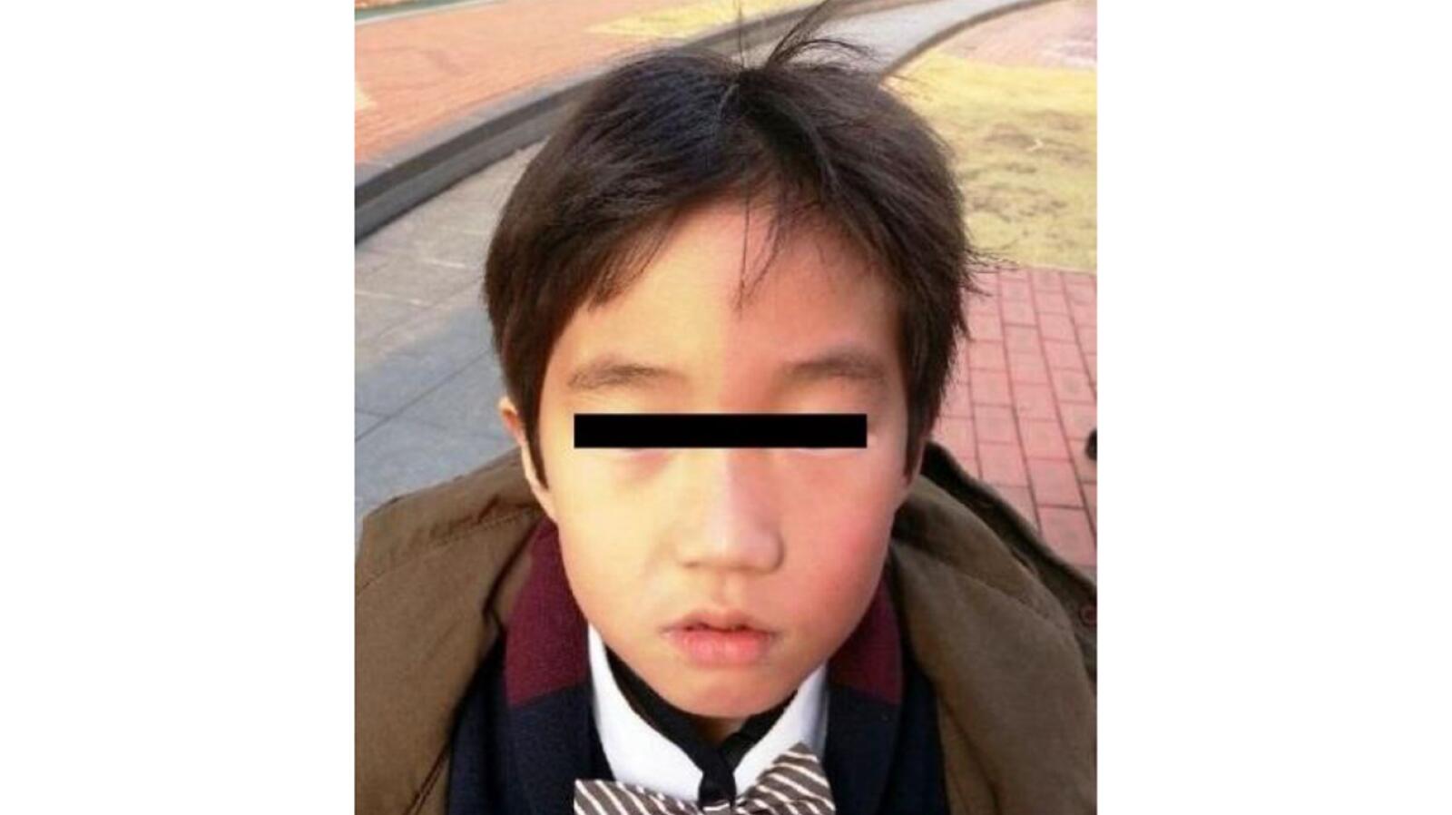 Harlequin Syndrome: Symptoms, Causes, Treatment, and More