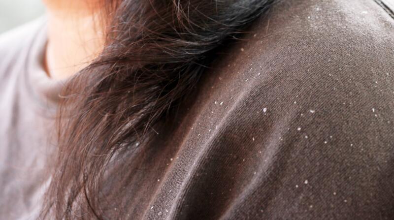 dandruff close up