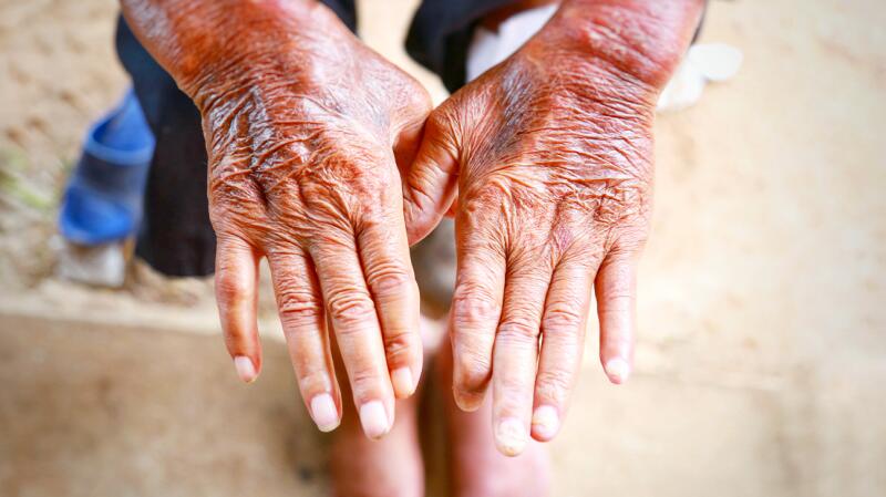 Scleroderma: Appearance, Symptoms, Causes, and More