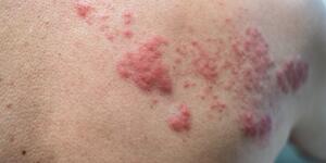 Itchiest Skin Conditions | What Skin Conditions Cause Itching?