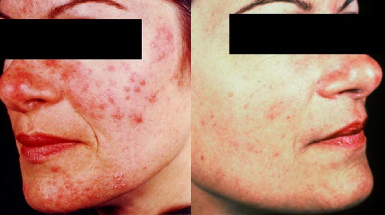 The Stages of Rosacea