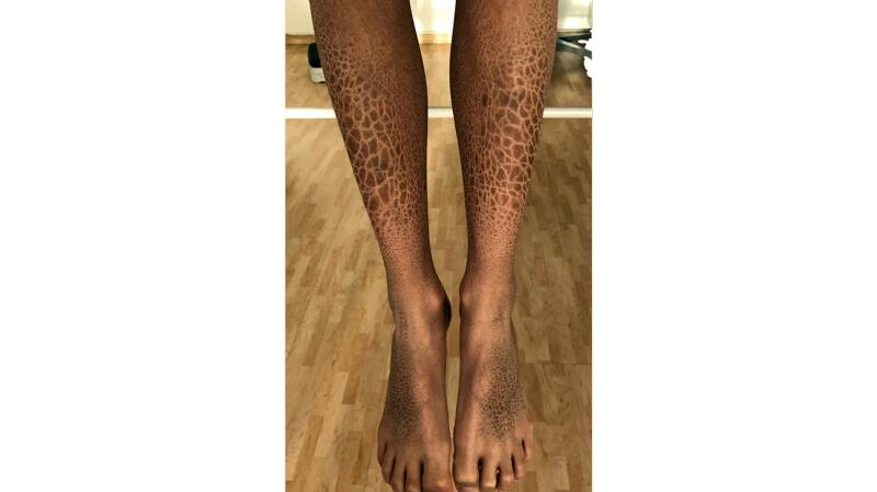 Ichthyosis Types Symptoms Causes And More