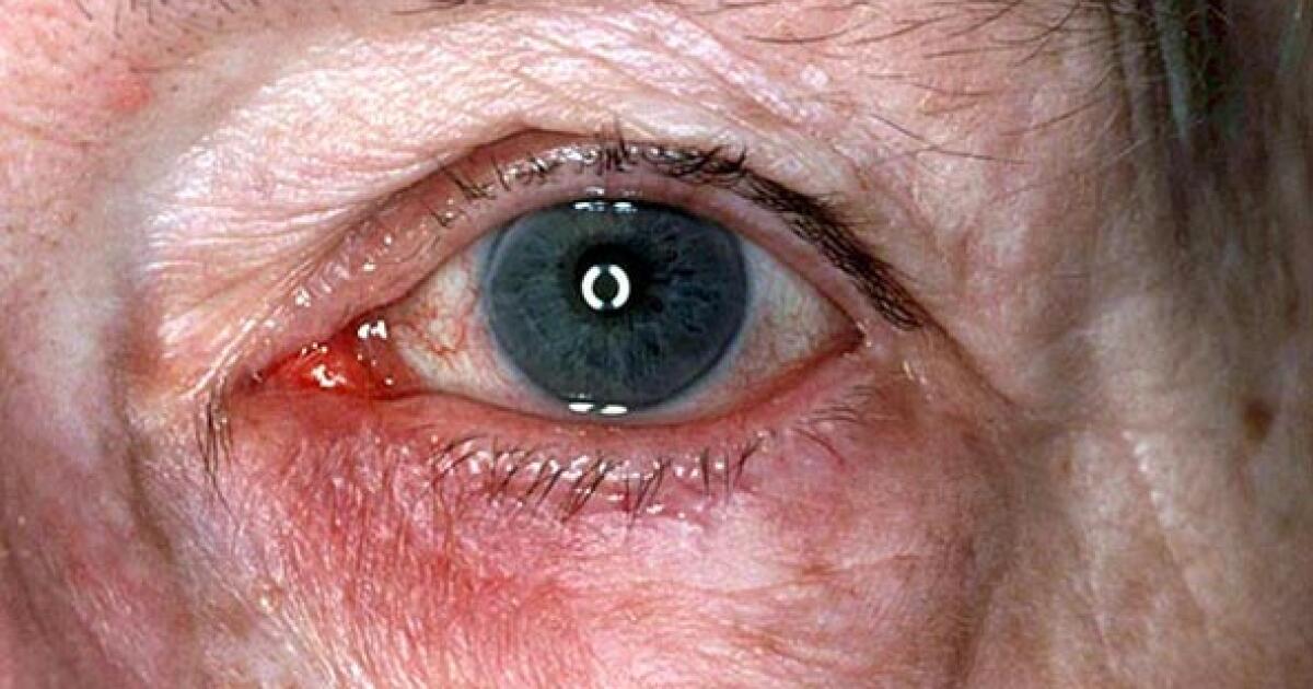 Eye Discharge - Symptoms, Causes, Treatments