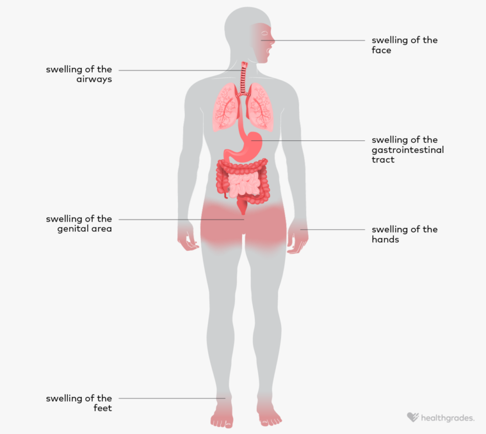 Hereditary Angioedema Causes Symptoms Treatments And More