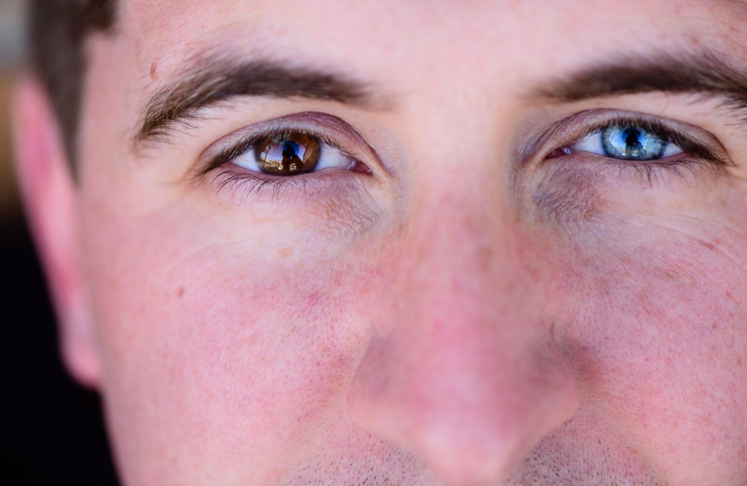 Heterochromia in Eyes: What It Is, Types & What Causes It - Healthgrades