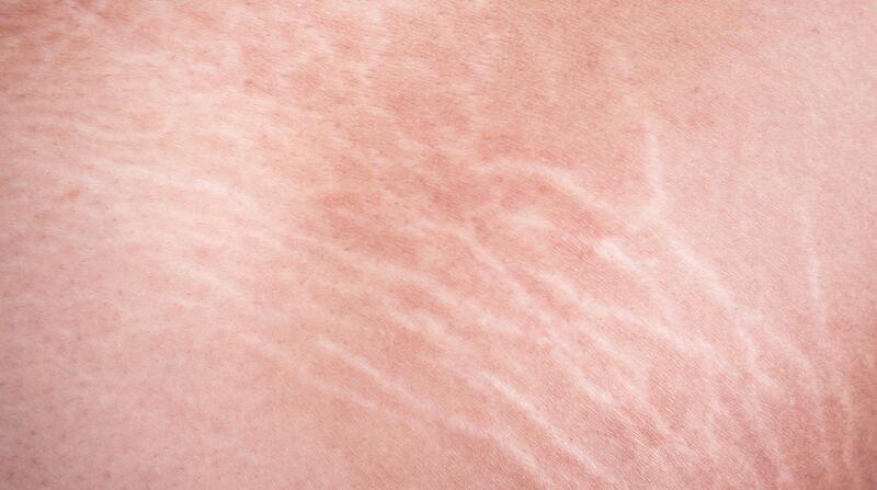 9 Things to Know About Stretch Marks: Causes & Treatments