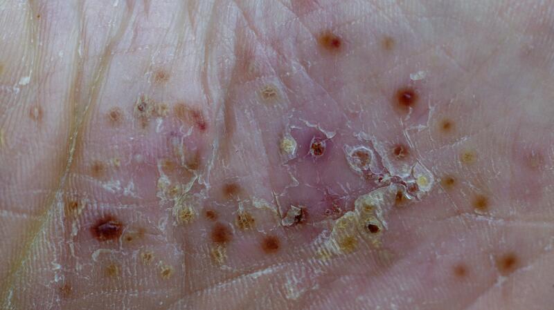 Psoriasis Symptoms Causes Pictures And Treatments