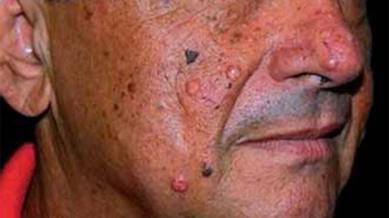 Muir-Torre Syndrome: Symptoms, Causes, Treatment, and More