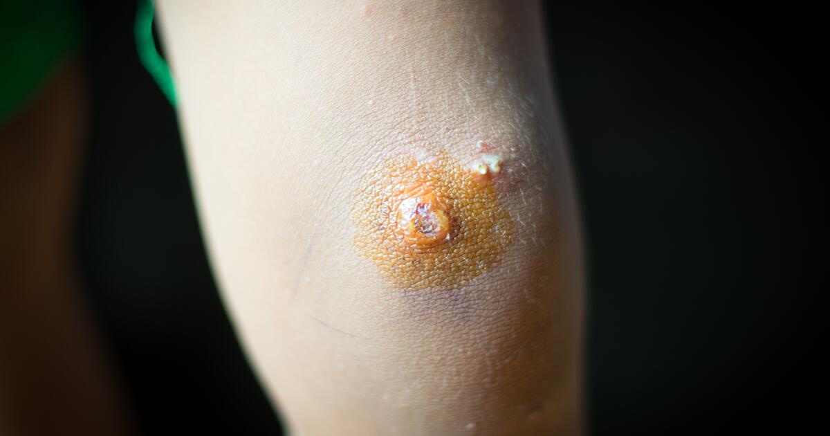 cream to treat cellulitis