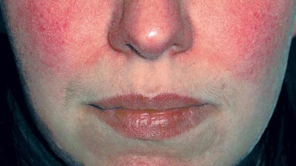 rosacea face