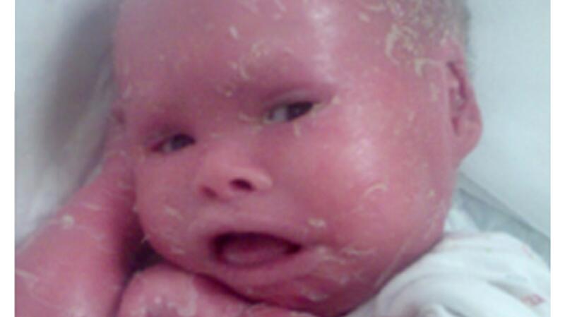 Ichthyosis Types Symptoms Causes And More