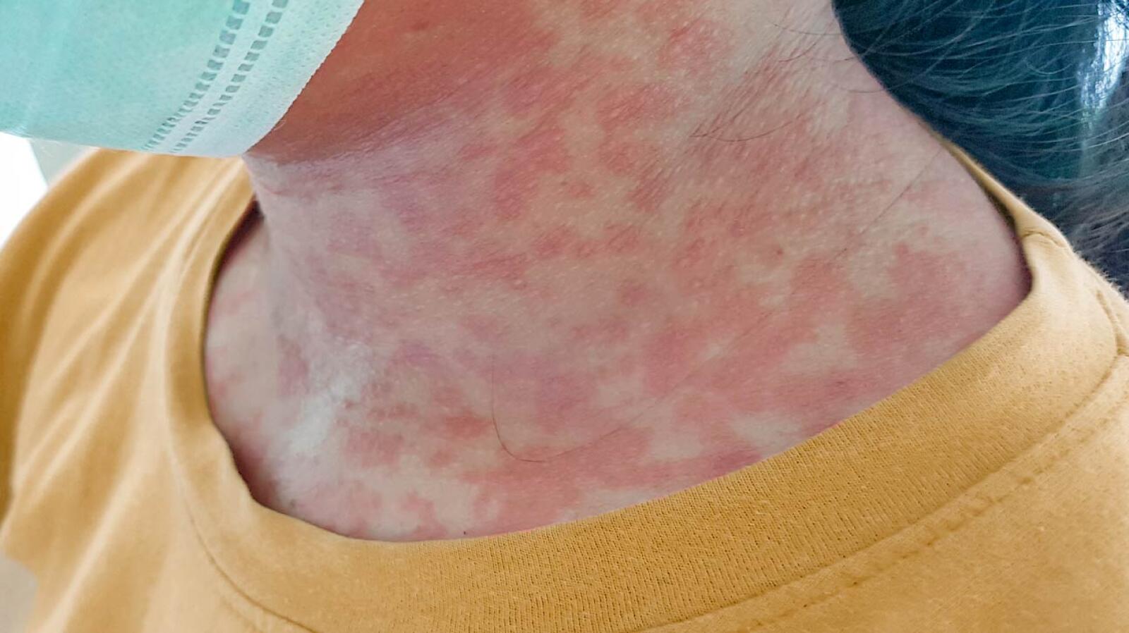 Rubella Symptoms Treatments Causes Vaccine And More Rubella Symptoms Treatments Causes Vaccine And More