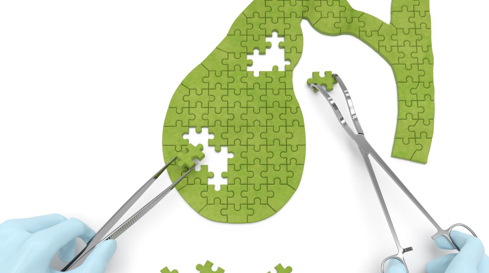 9 Things to Know About Gallbladder Removal | Cholecystectomy Facts