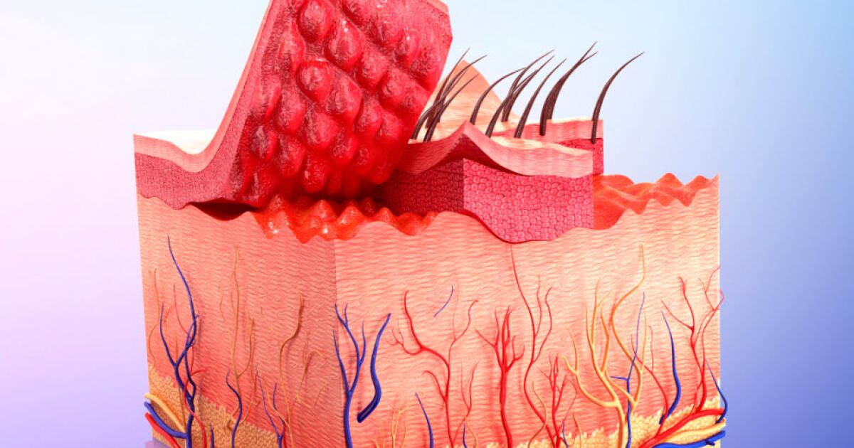 Carbuncle - Symptoms, Causes, Treatments