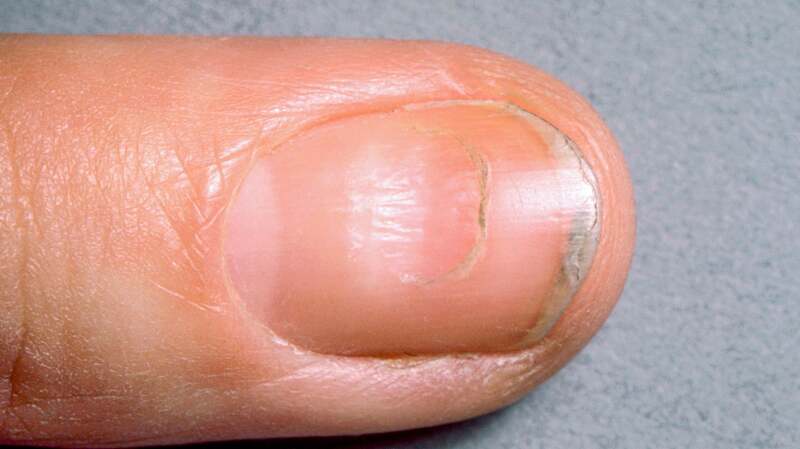 Psoriatic Arthritis Nails: Symptoms, Treatment, and More