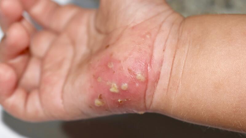 How to Identify Scabies: Symptoms, Pictures, Causes, and More