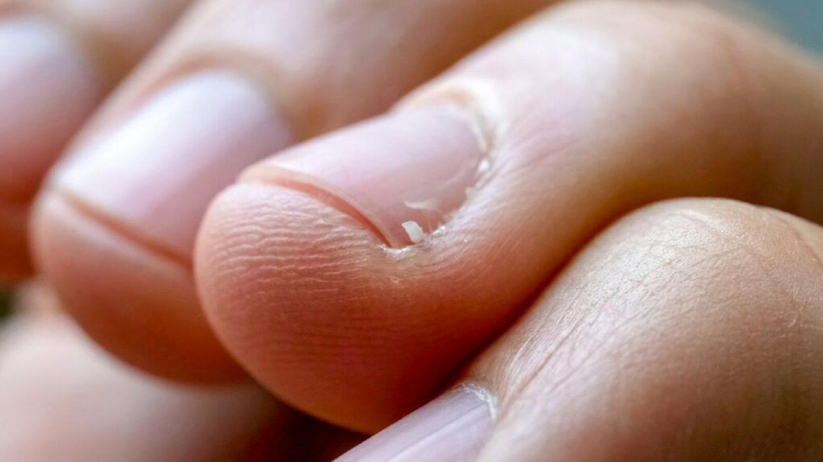 Hangnail: Causes, Symptoms, and Treatment