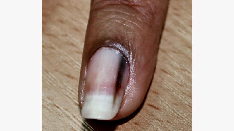 Melanonychia: Pictures, Types, Symptoms, Causes, and More