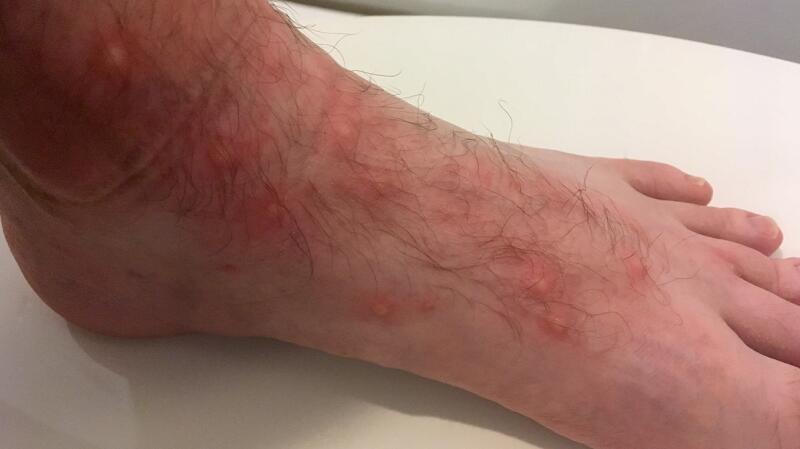 Chigger Bites Treatment Prevention And More