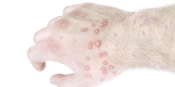 What Different Types of Psoriasis Look Like | Psoriasis Pictures