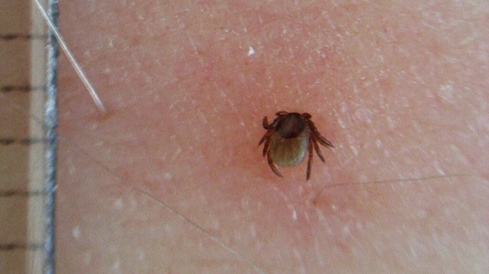 Tick Bite: Pictures, Symptoms, Treatments