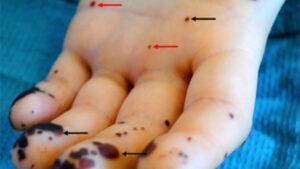 janeway lesions feet