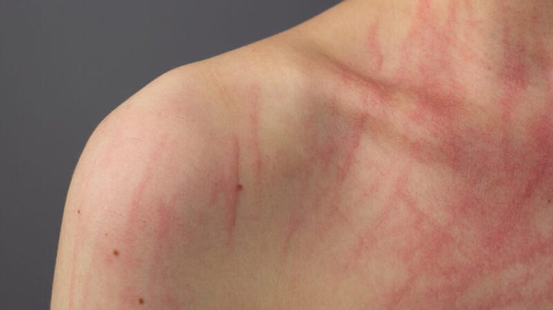 Dermatographia: Symptoms, Causes and Treatment