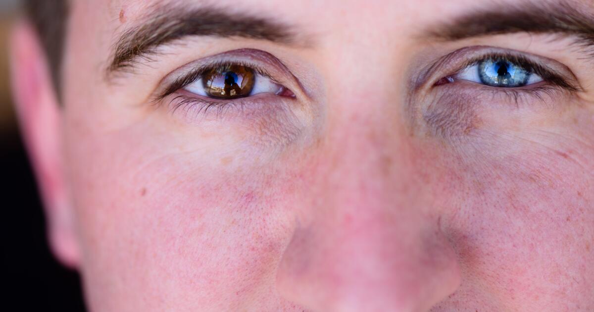 Heterochromia in Eyes: What It Is, Types & What Causes It - Healthgrades