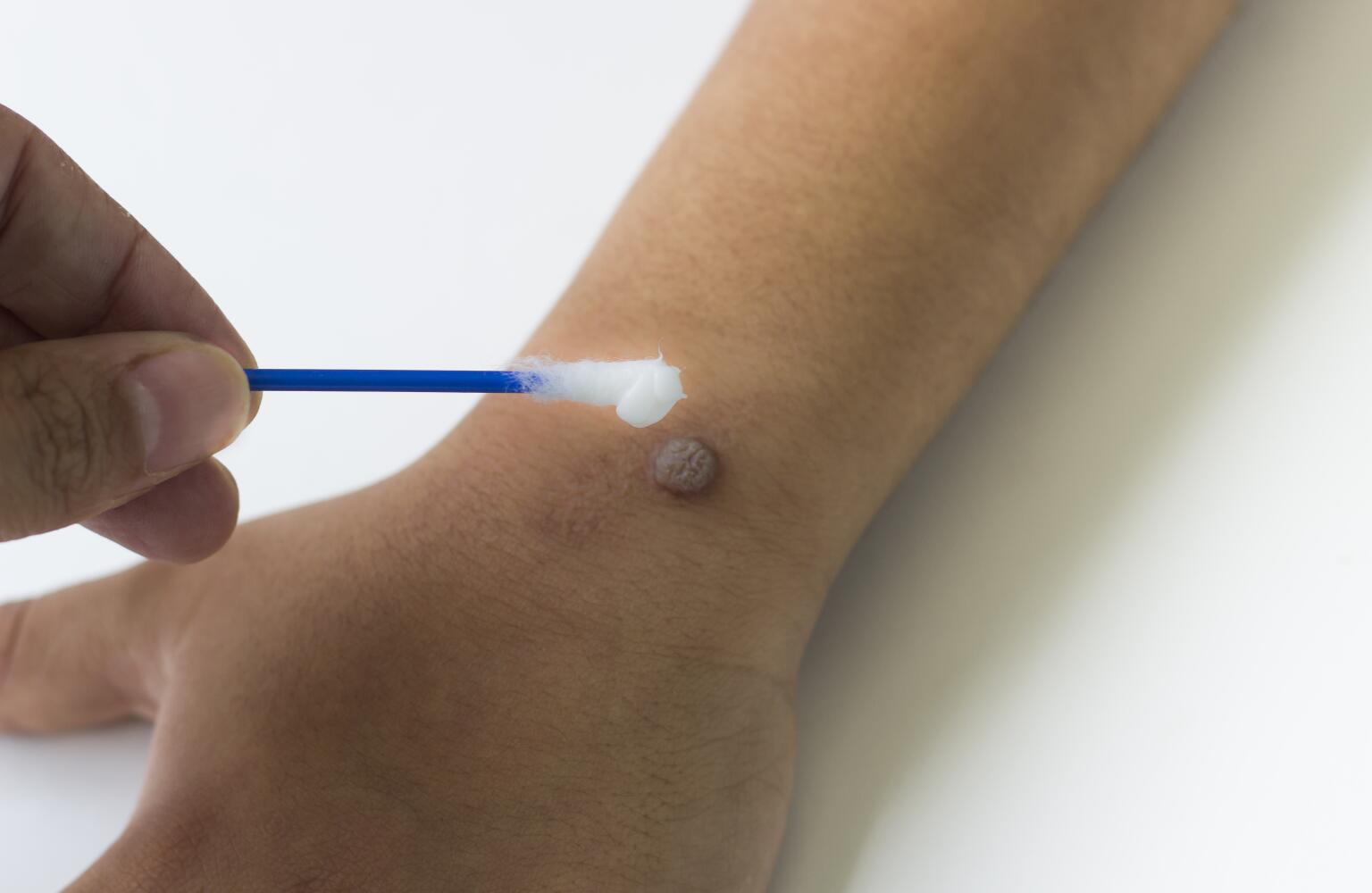 Warts: Types, Causes, Symptoms, Treatments & Removal - Healthgrades