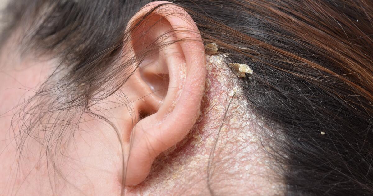 Ear Psoriasis | Psoriasis on the Ears