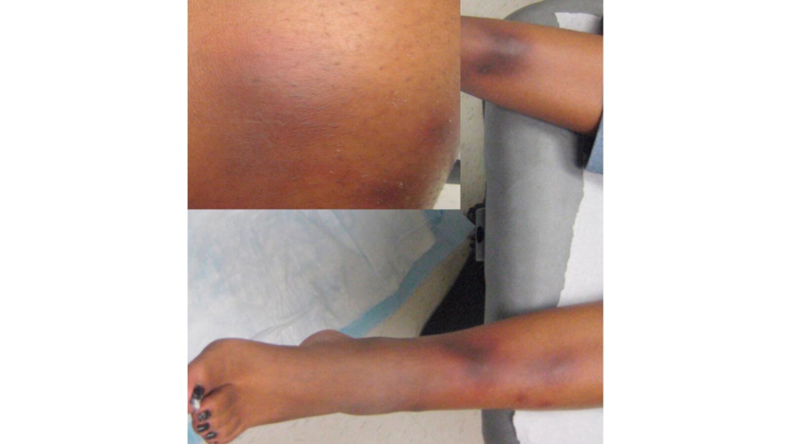 Panniculitis: Types, Symptoms, Treatment, and More