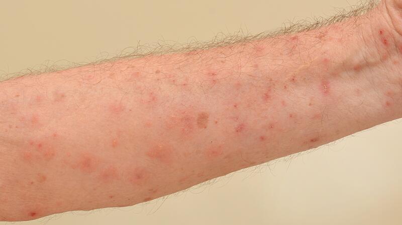 How to Identify Scabies: Symptoms, Pictures, Causes, and More