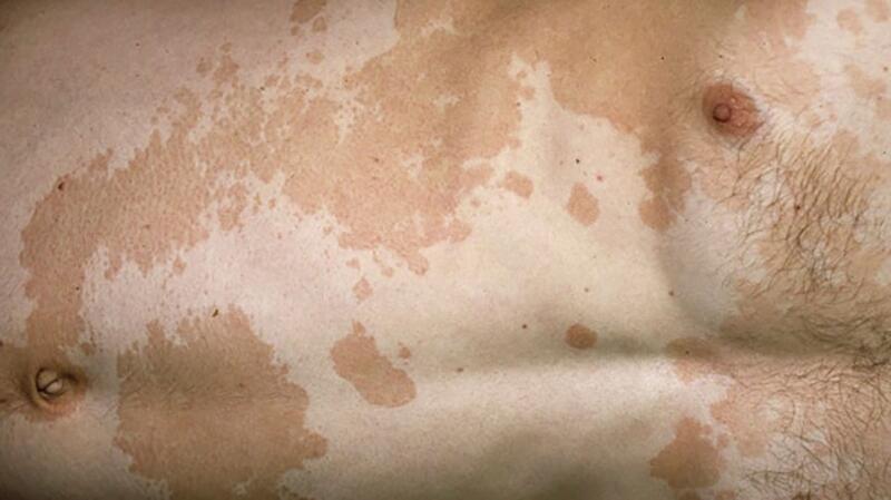 hypopigmentation spots