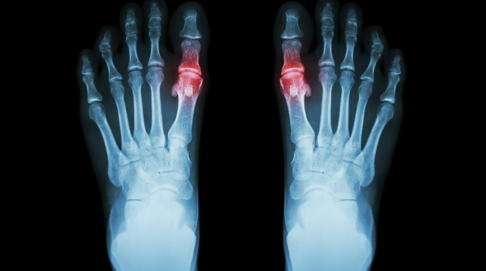 What Gout Looks Like