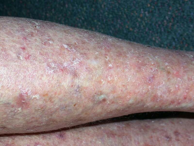 basal cell carcinoma on leg for years