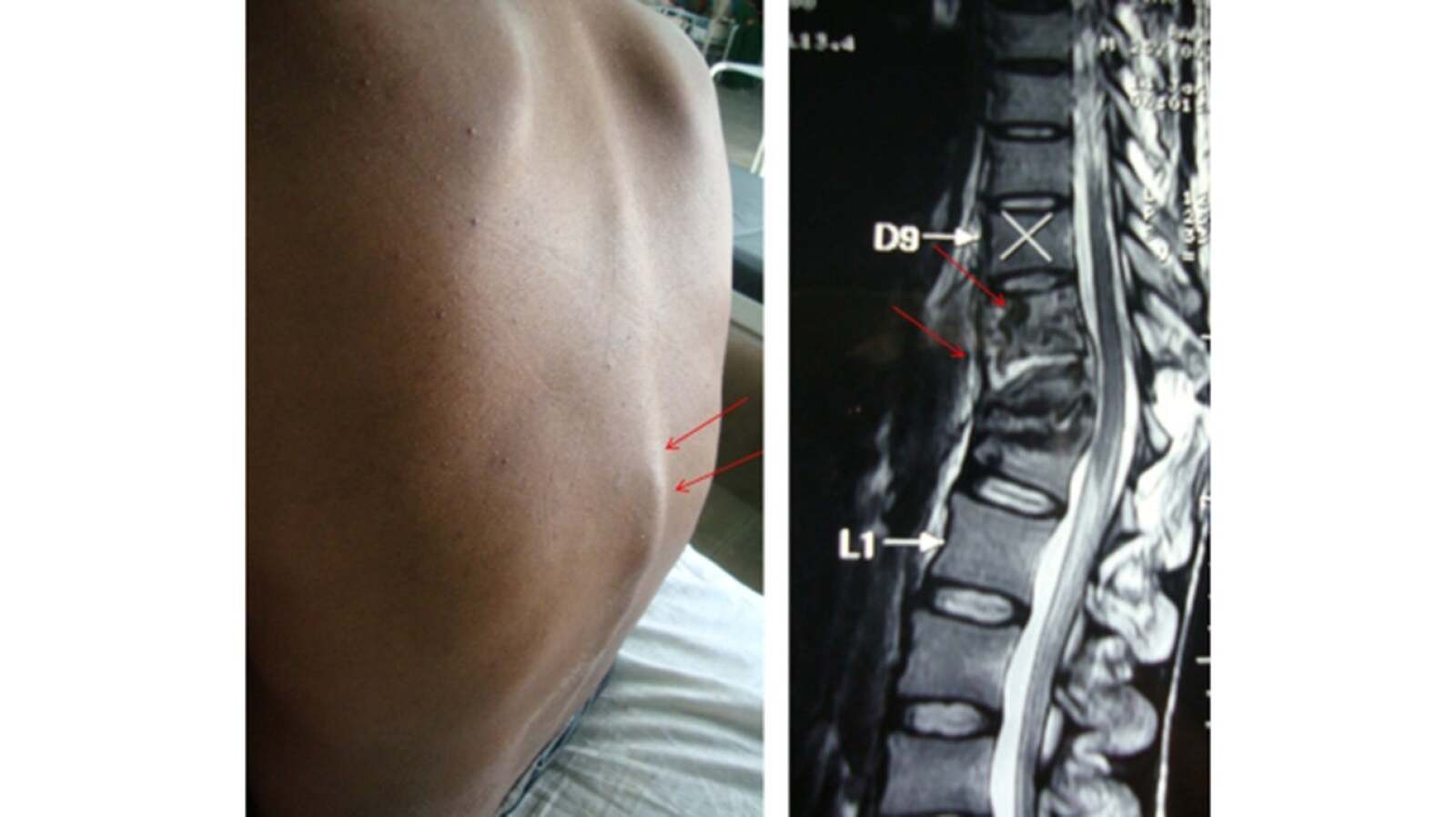 Spinal Tuberculosis: Causes, Symptoms, Treatments, and More