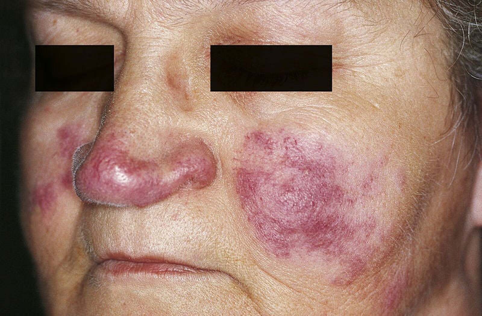 Lupus Rash Vs Rosacea Symptoms Causes Treatments