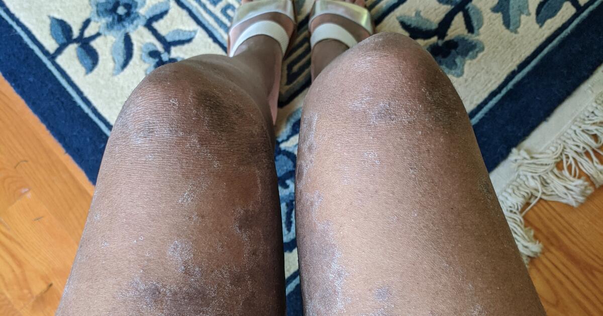 black eczema
