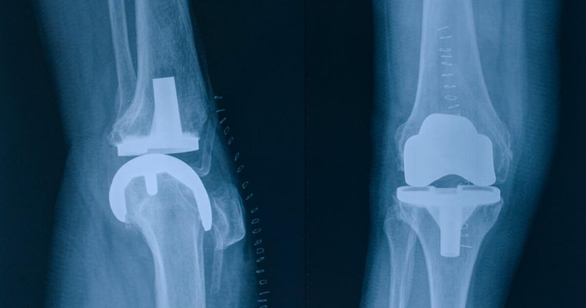How 3D Printed Knee Replacements Work