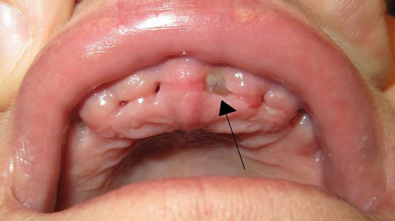 dry socket healing time nhs