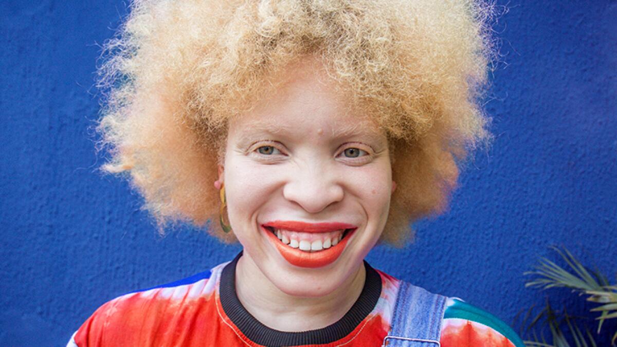 Albino Person Red Eyes