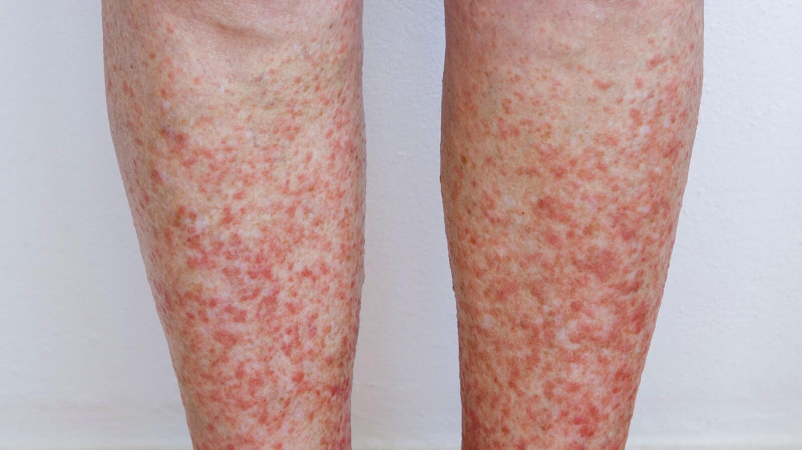 Sun Rash: Types, Causes, and Treatments