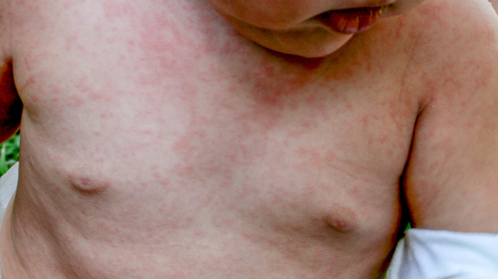 Roseola: Causes, Symptoms, and Treatment